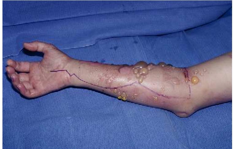 Figure 3 - Management of Forearm Compartment Syndrome