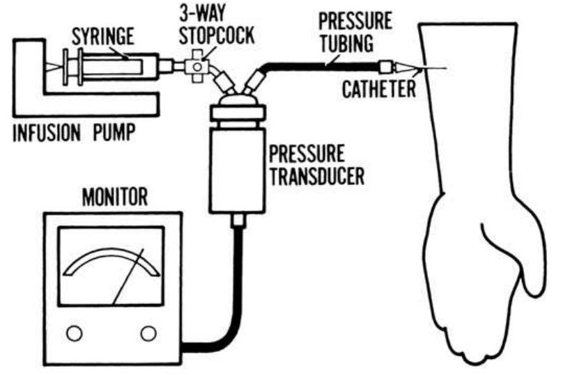 Diagram of compartment pressure monitor setup using fluid