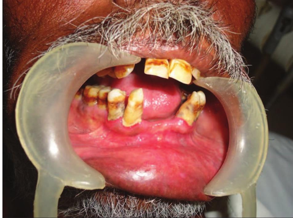 Epulis Granulomatosa Post Extraction