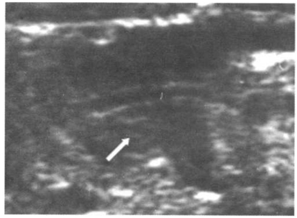 A. hypertrophic pyloric stenosis (hps): longitudinal view on