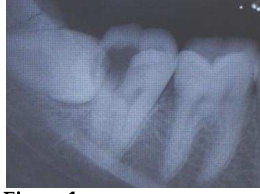 Clinical examination revealed deep disto-occlusal dental