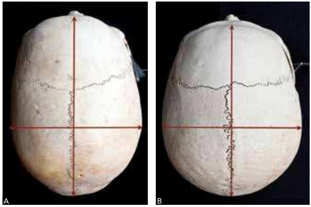 (PDF) Brachycephalic, dolichocephalic and mesocephalic: Is it ...