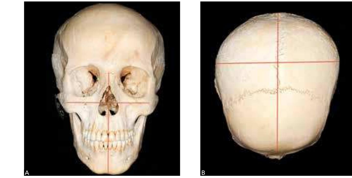 (PDF) Brachycephalic, dolichocephalic and mesocephalic: Is it ...