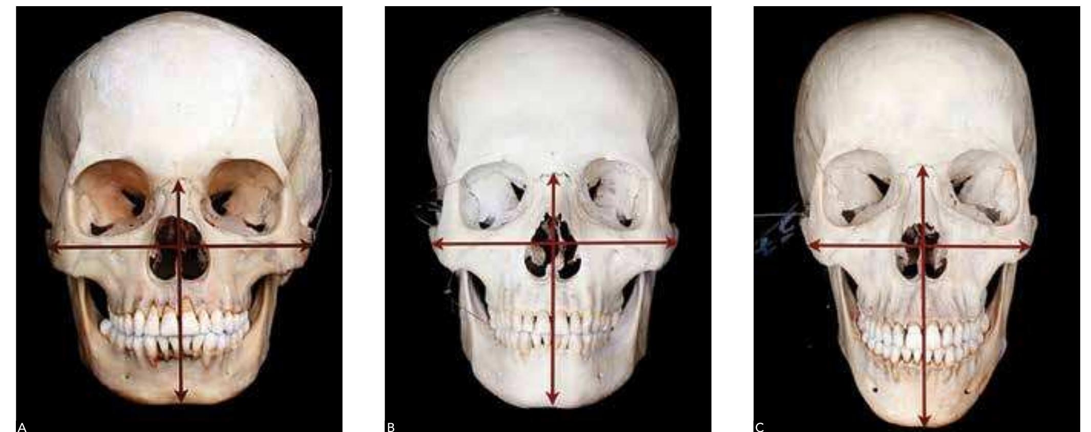 (PDF) Brachycephalic, dolichocephalic and mesocephalic: Is it ...