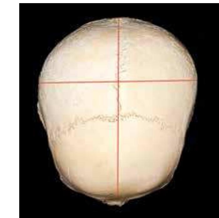 (PDF) Brachycephalic, dolichocephalic and mesocephalic: Is it ...