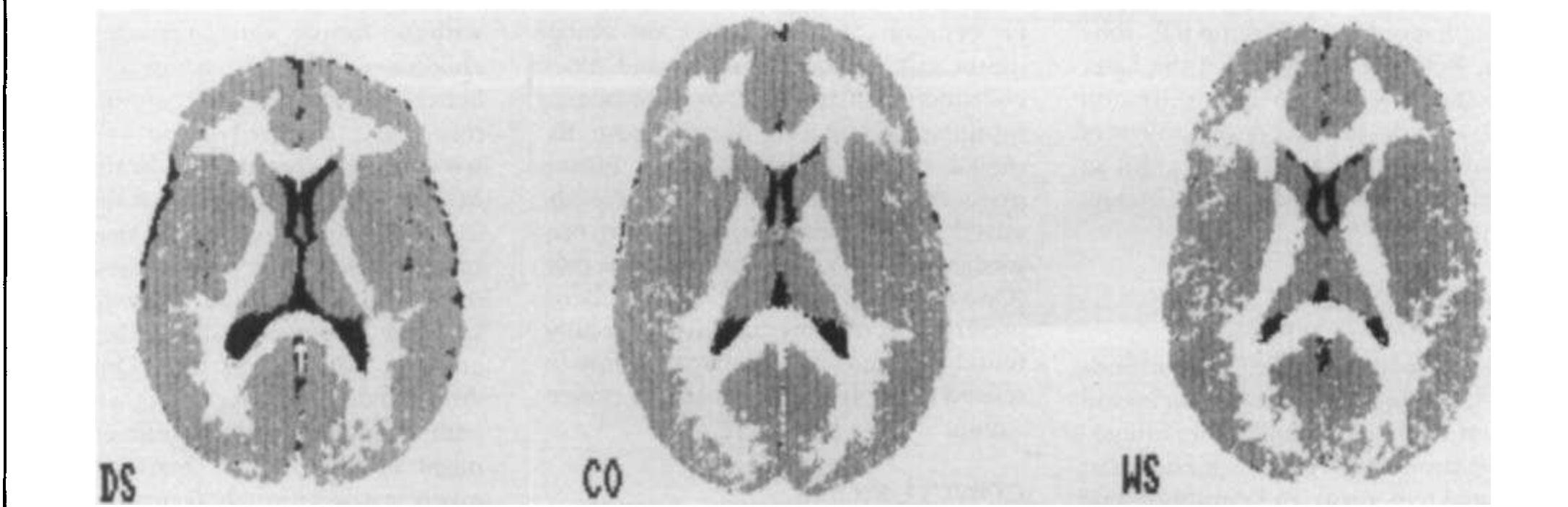 Typical brain morphology in down syndrome and williams