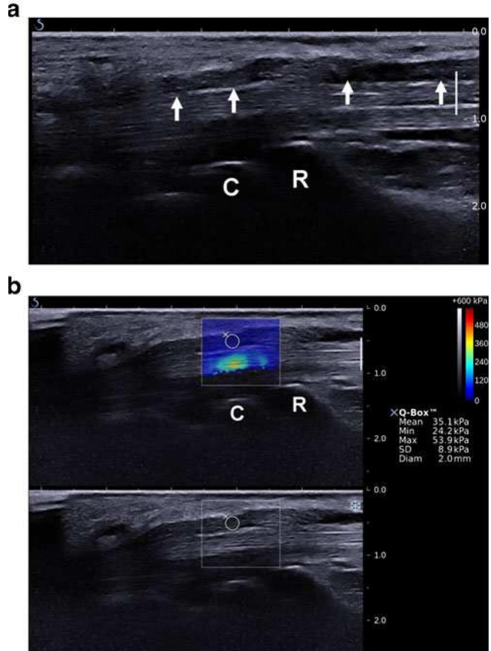 A sagittal ultrasound image of the right wrist in a healthy