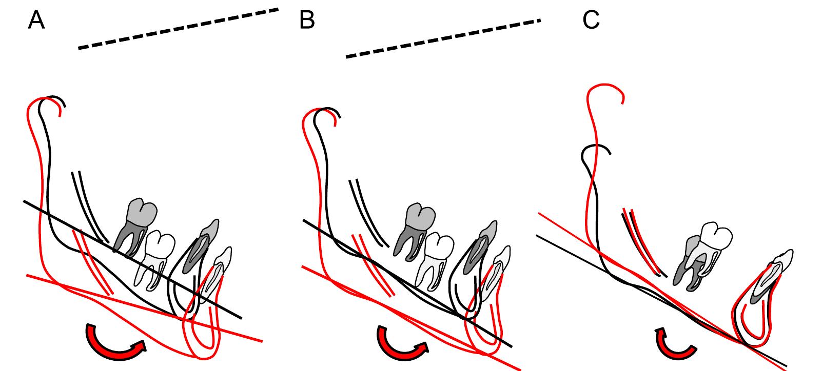 (a) true or total rotation of the mandible's implant or