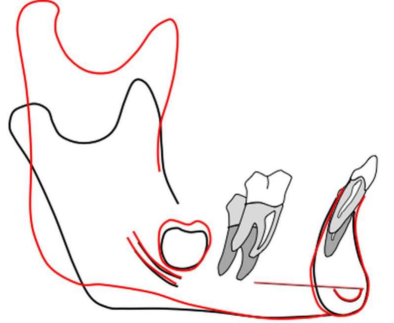 Figure 3 - Mandibular rotation revisited: What makes it so