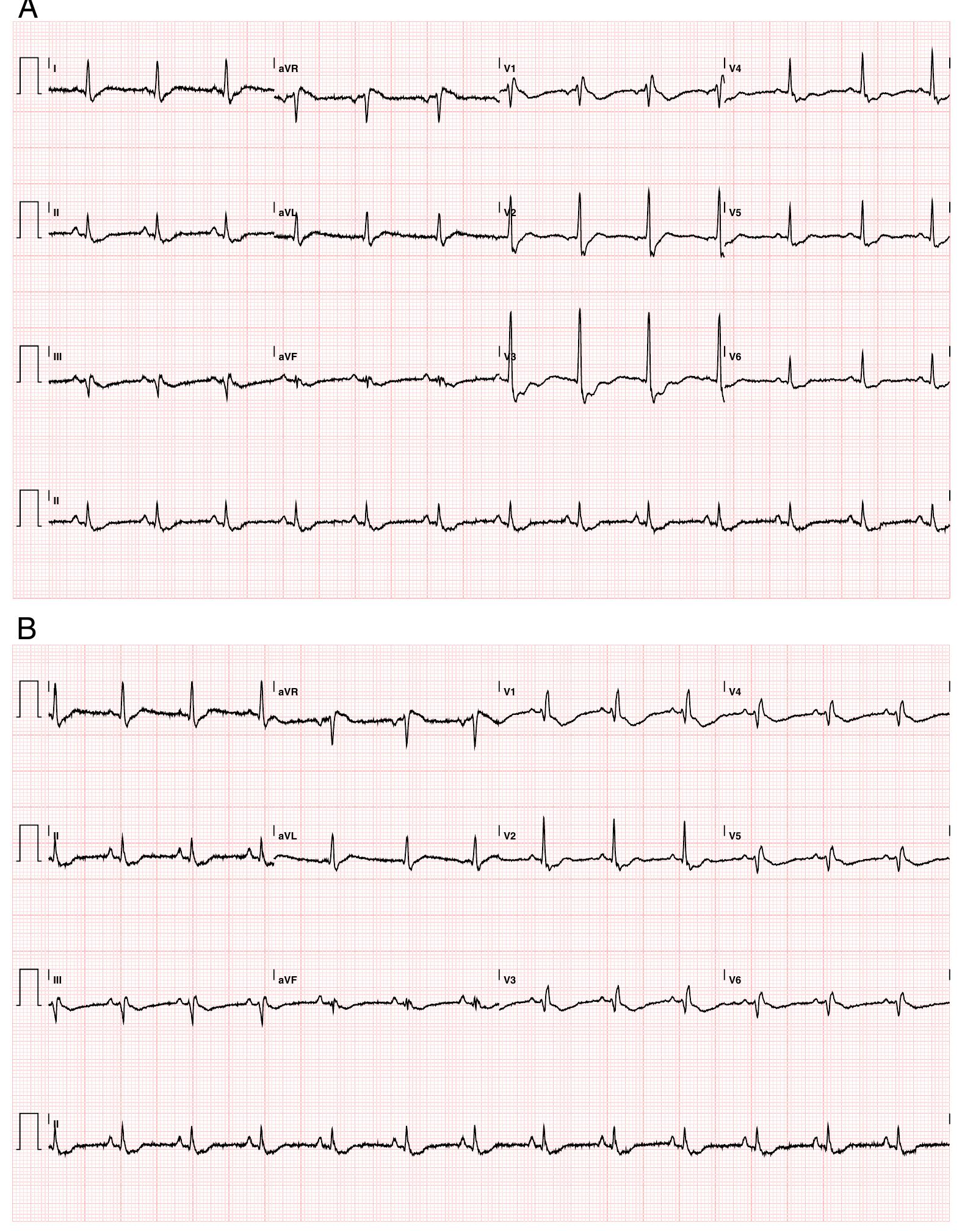A, twelve-leads ecg showing sinus rhythm, rbbb pattern with