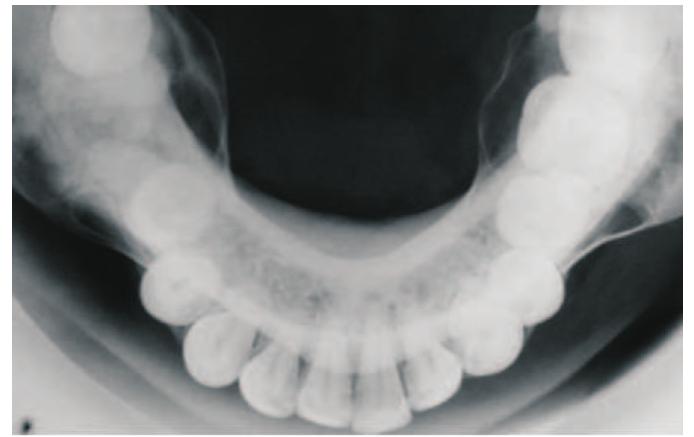 Radiographic: cross sectional maxillary occlusal projection