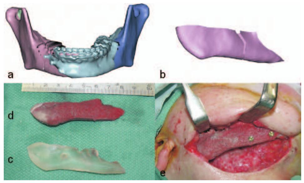 Surgical planning of onlay bone grafting. a, a mirror image