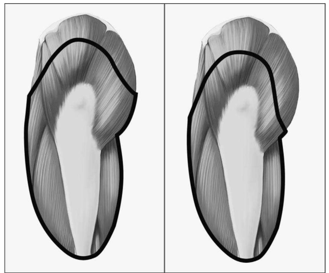Left panel: ischial containment socket’s shape; right panel: