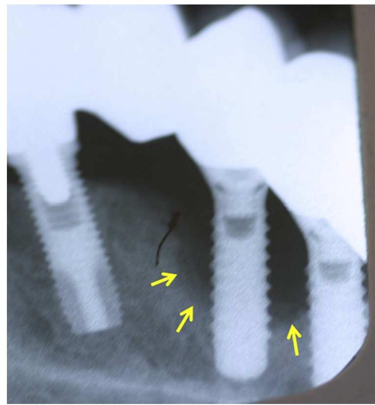 A peri-apical radiograph showing crestal bone (yellow