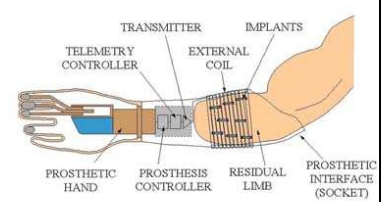 Schematic of planned implanted myoelectric sensor (imes)