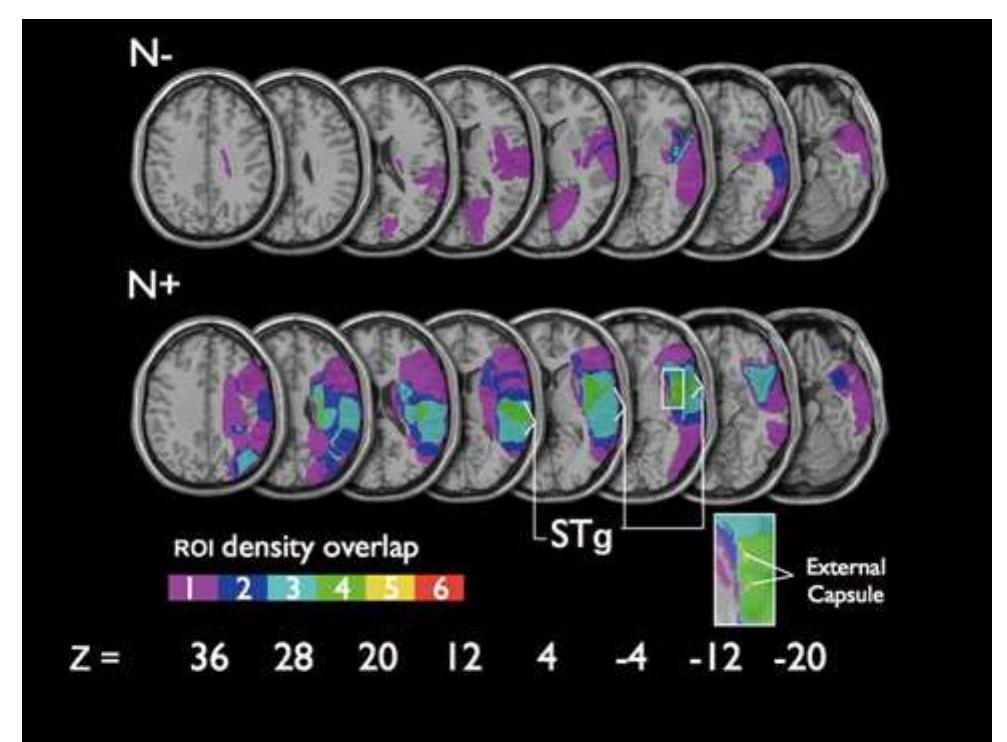 N—: overlay lesion plots of the patients with right brain