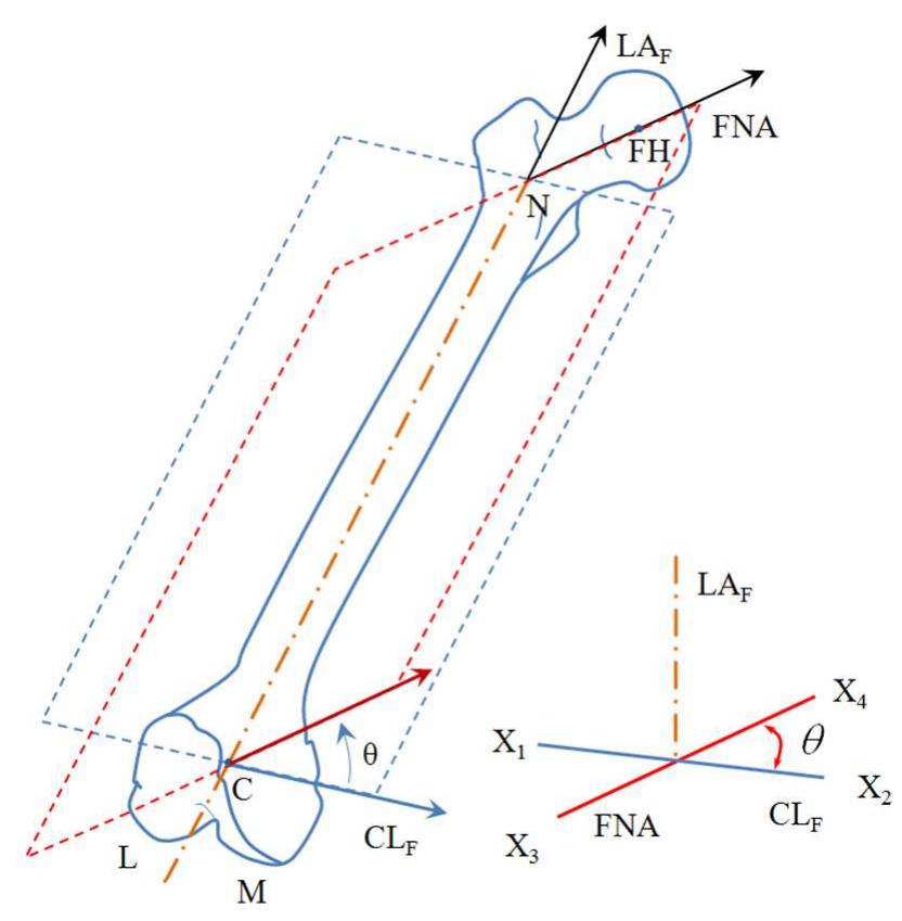 Method of measuring femoral torsion computerized assessment