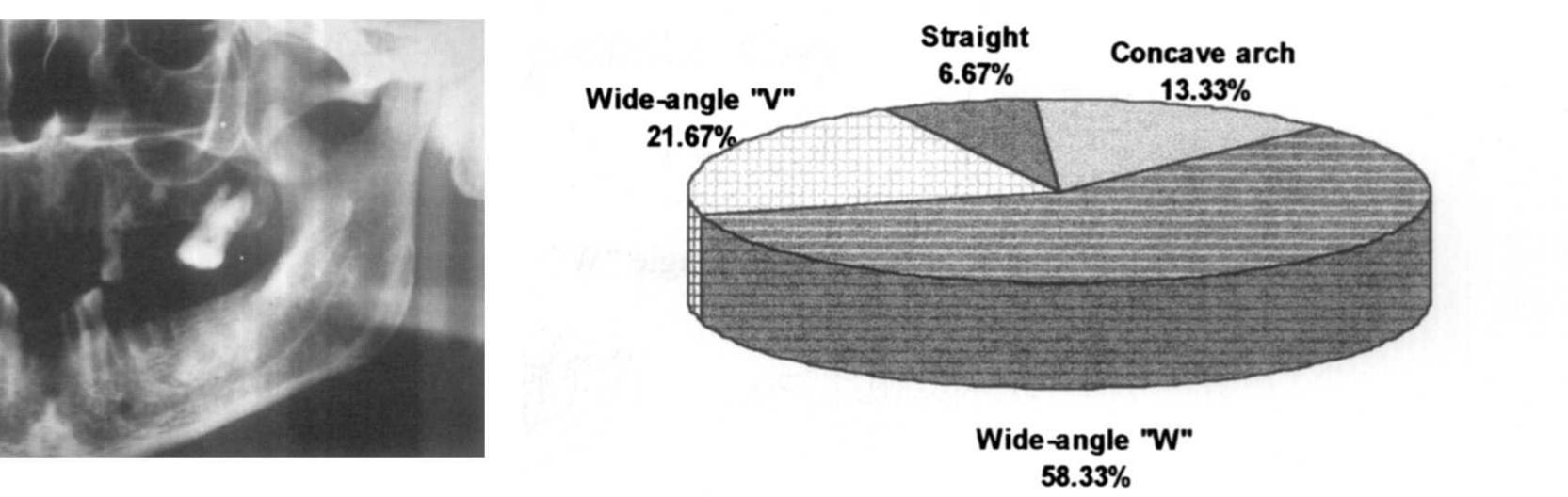 Frequency of shapes of hard palate and nasal fossa floor