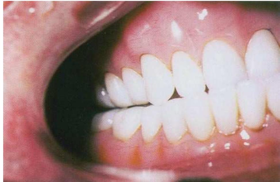 Anterior premature tooth contact and posterior tooth
