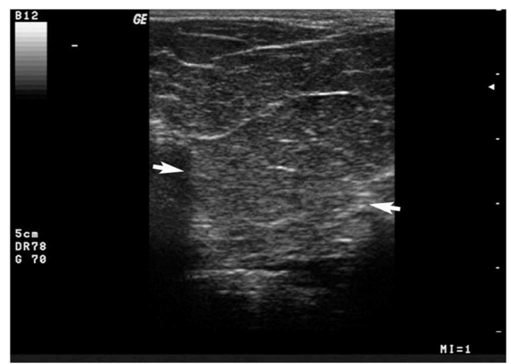 Figure 3 - Canine lipomas treated with steroid injections: