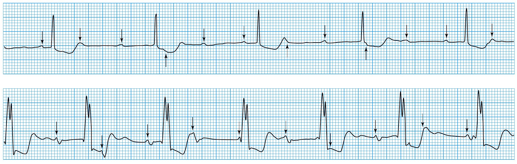 Third degree heart block. a pacemaker in the bundle of his