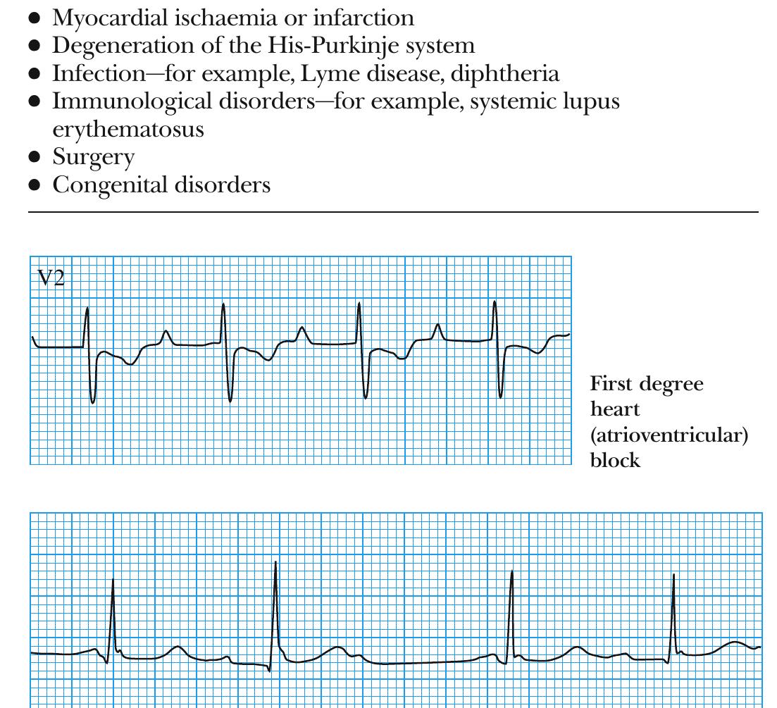 Causes of atrioventricular conduction block mobitz type i