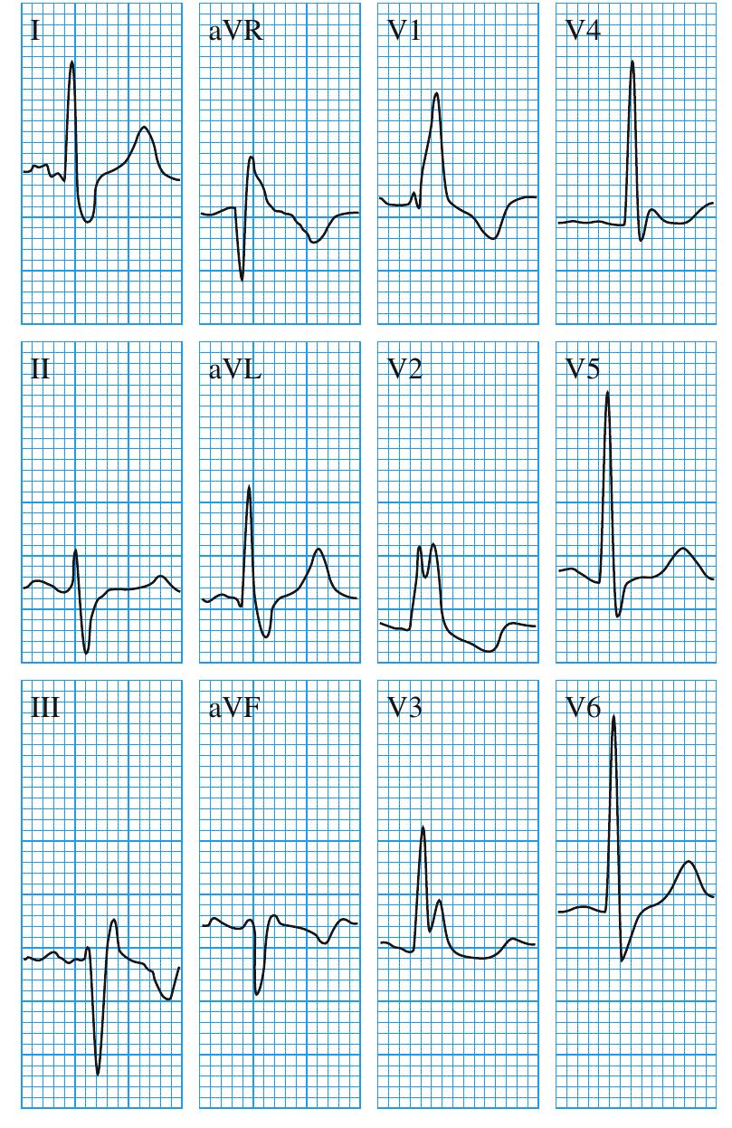 Right bundle branch block, showing the wave of