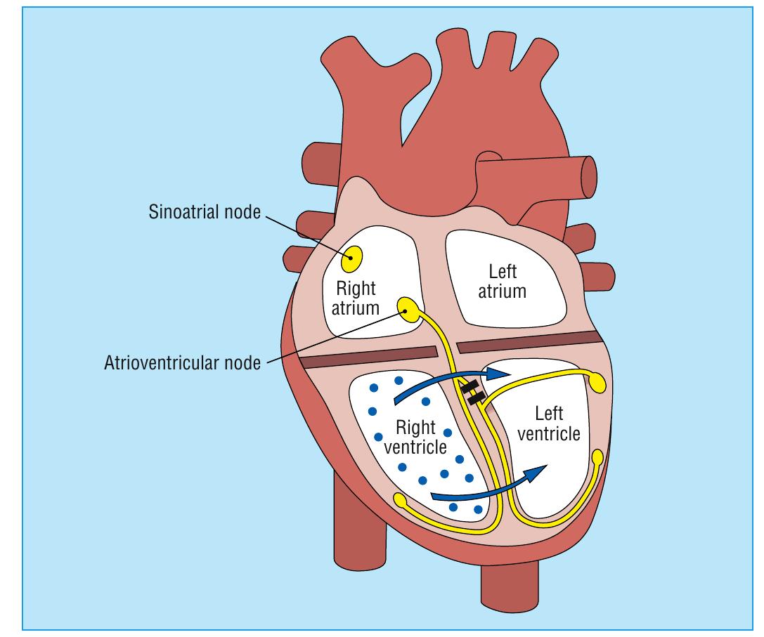 Left bundle branch block, showing depolarisation spreading