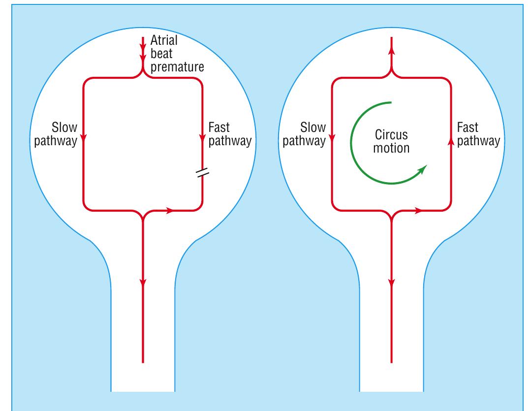 A premature atrial impulse finds the fast pathway