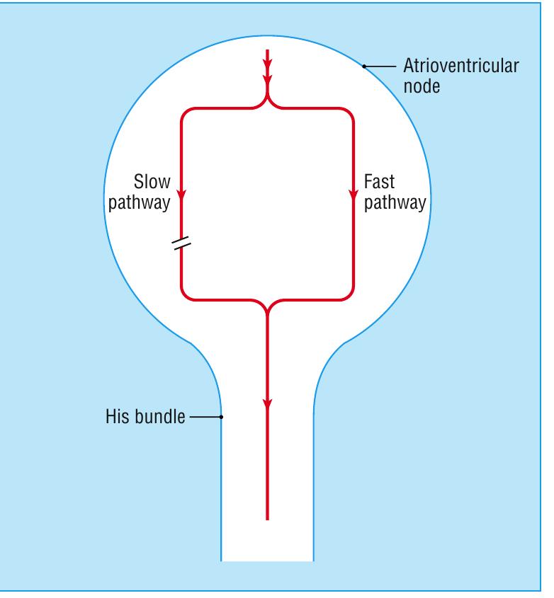Mechanism of atrioventricular nodal re-entrant tachycardia