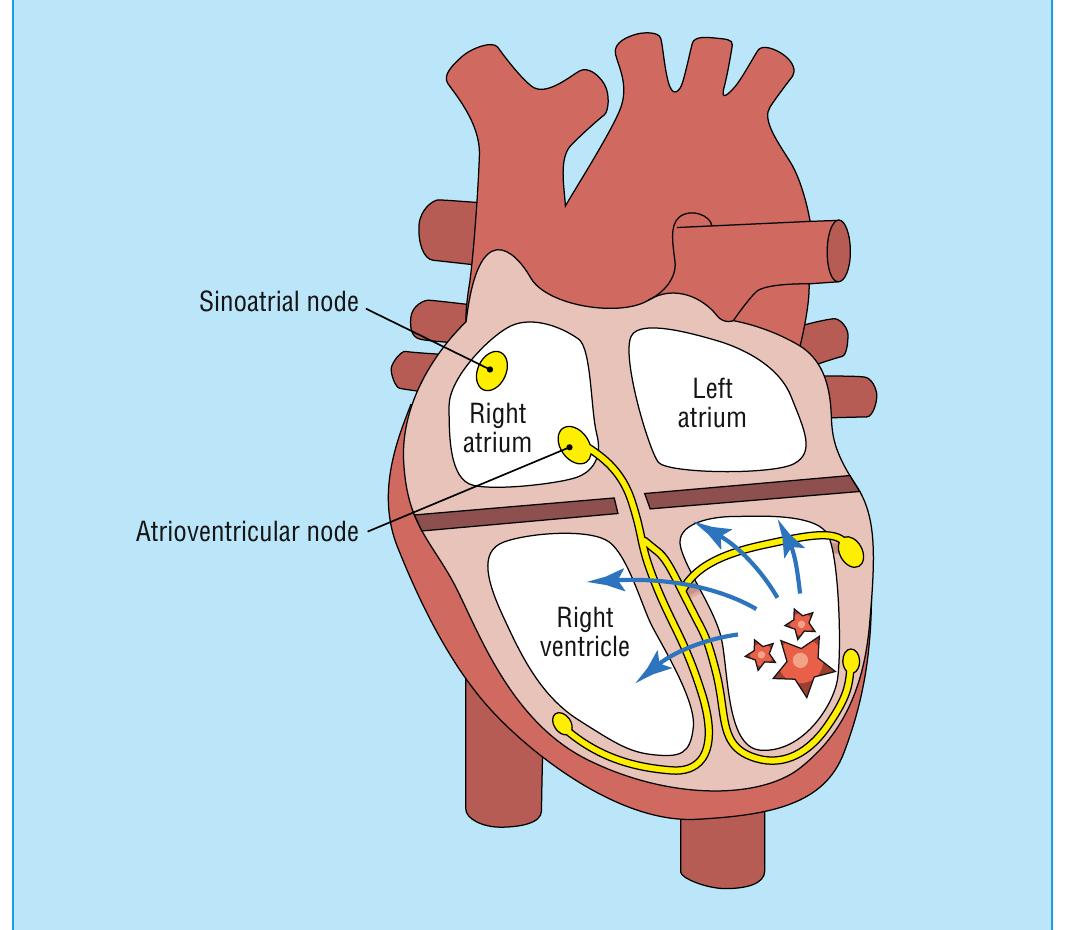 Ventricular tachycardia showing abnormal direction of wave
