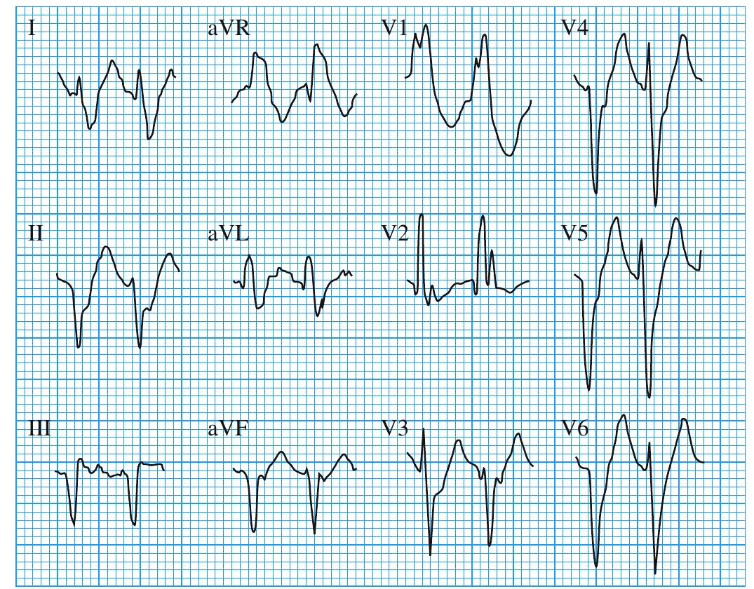 Fascicular ventricular tachycardia (note the right bundle
