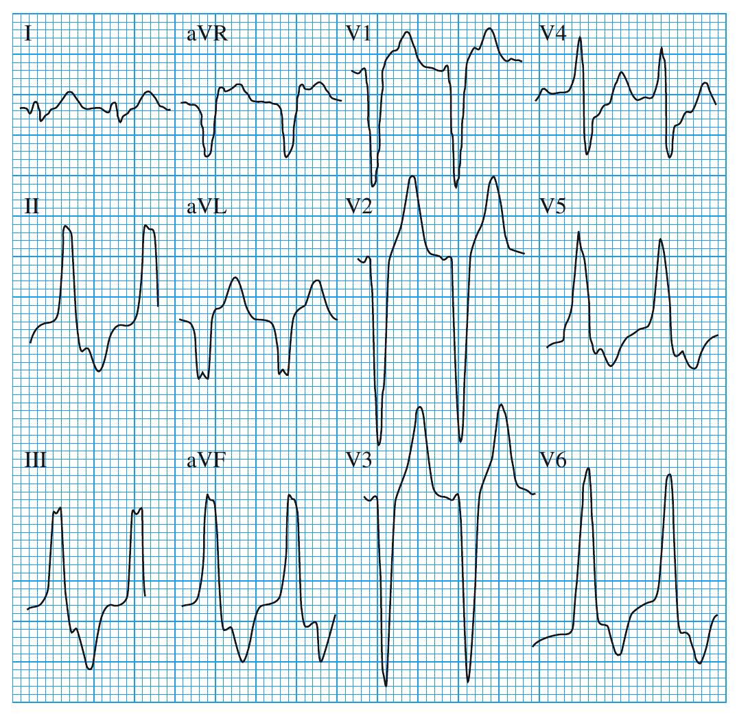 Right ventricular outflow track tachycardia