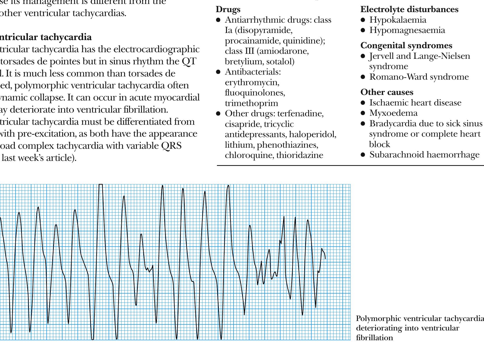 Broad complex tachycardias of supraventricular origin abc of