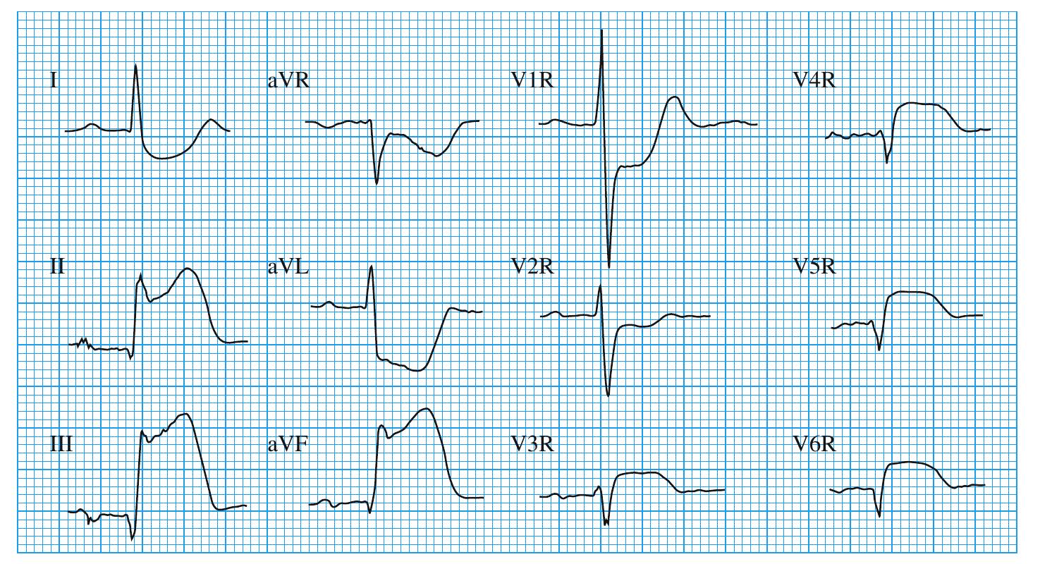 Acute inferior myocardial infarction with right ventricular