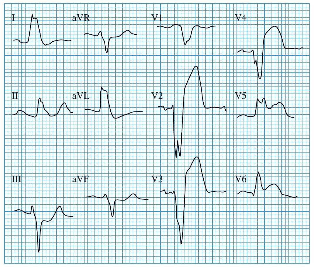 Acute myocardial infarction and left bundle branch block.