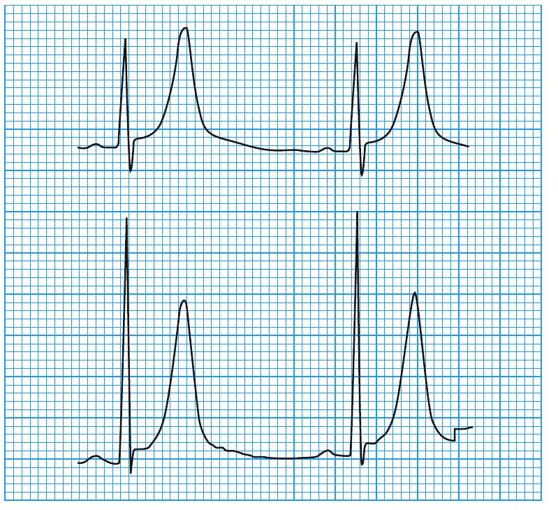 ‘tall t waves in leads v2 and v3 in patient with recen