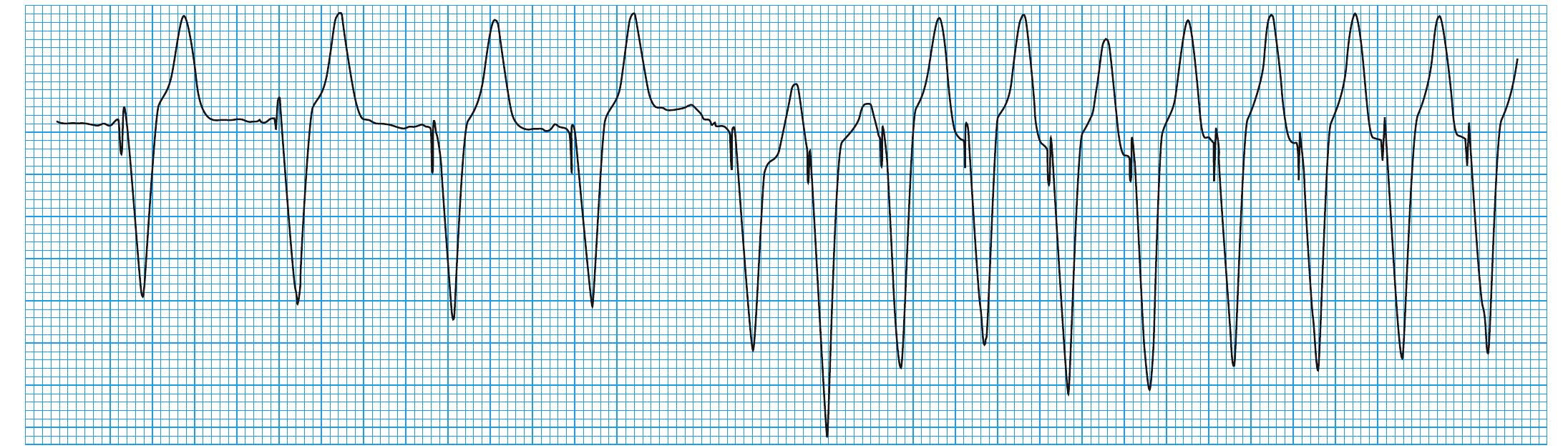 Pacemaker syndrome pacemaker syndrome refers to symptoms