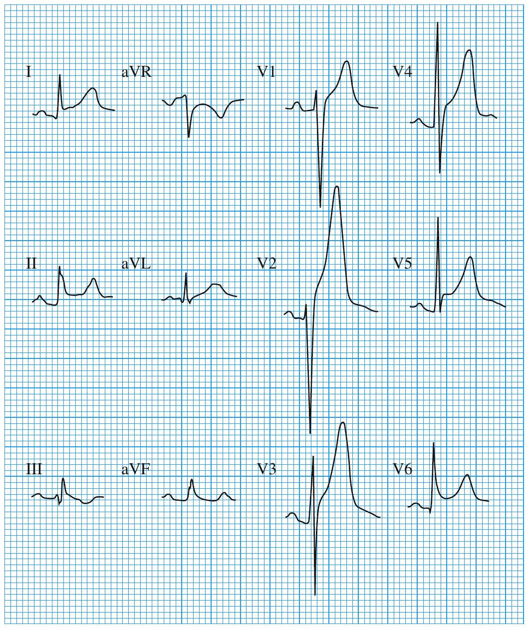 Pericarditis: note the st elevation and pr segment