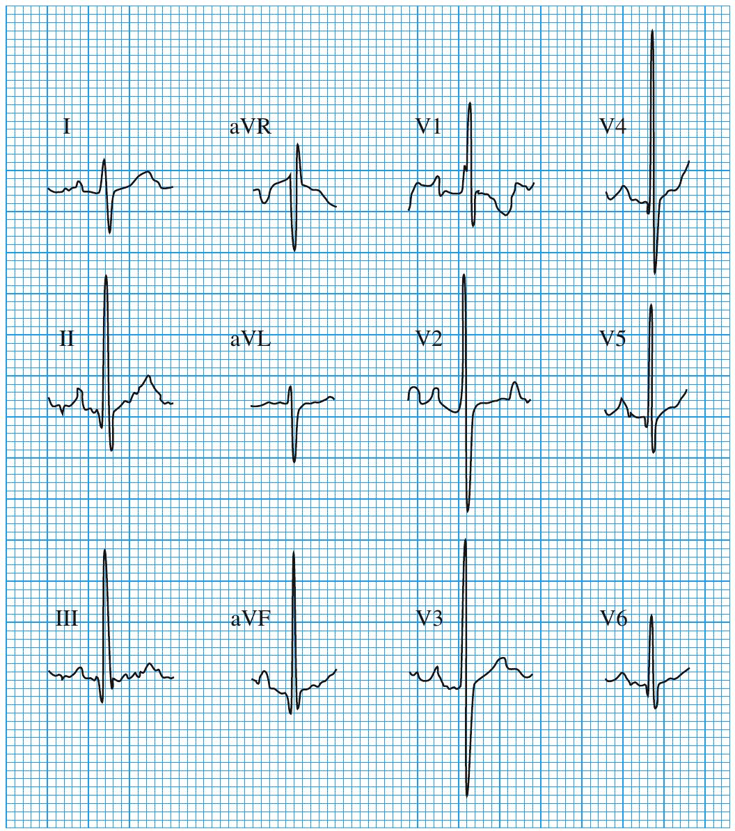 Secundum atrial septal defect: note the right axis deviation