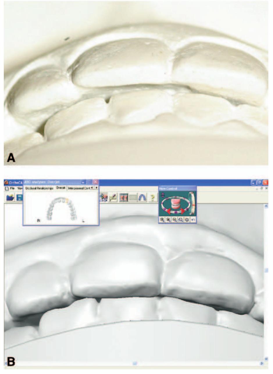 A, plaster cast: anterior view showing positive overjet. b,