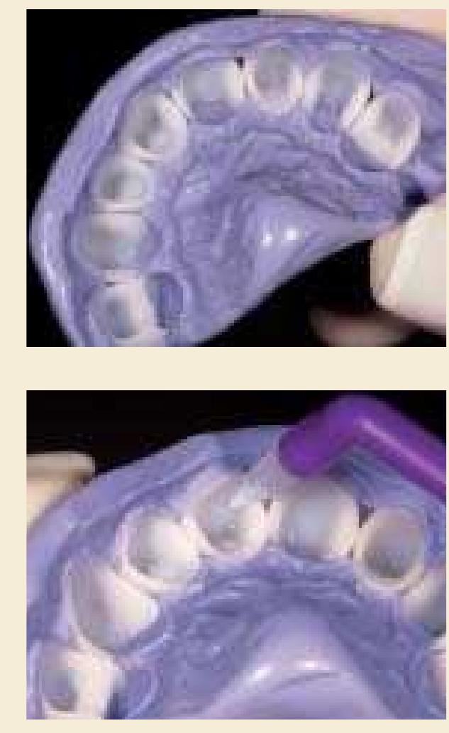Cementation sequence depends on the arrangement of proximal