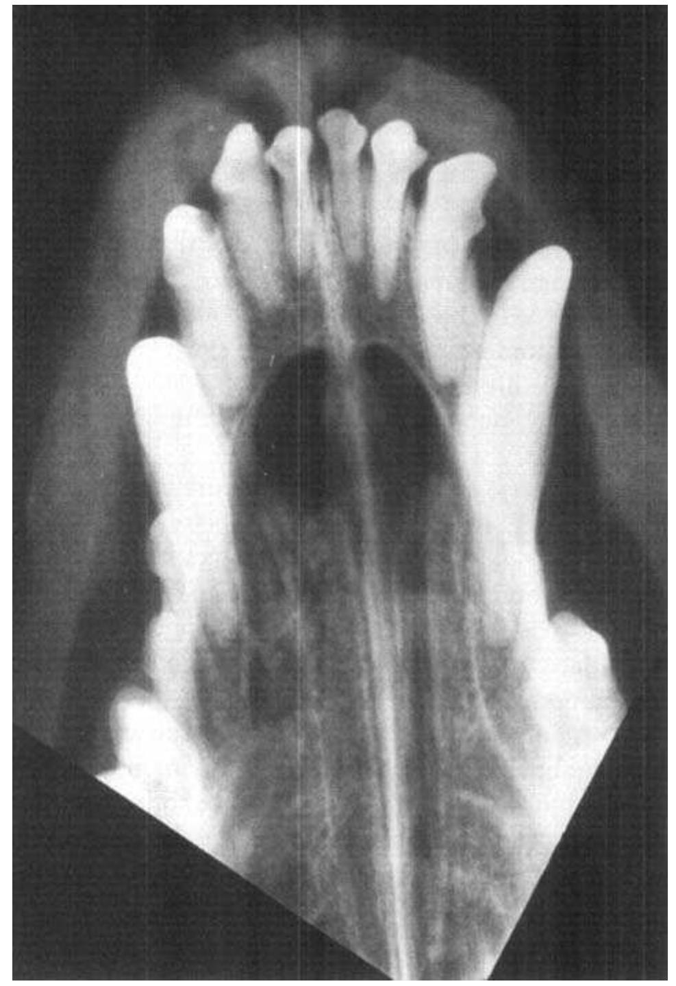 An occlusal radiograph, taken 2 '% years after surgery. the