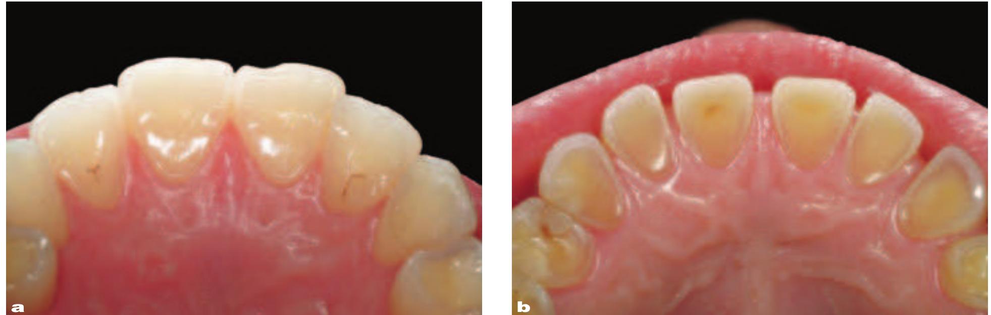 Maxillary occlusal view of the palatal aspect of two