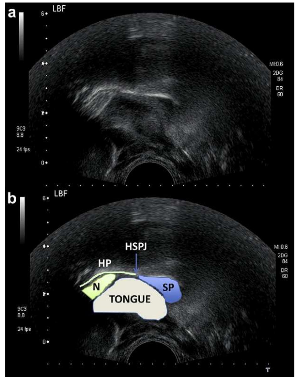 (a) typical submental midsagittal ultrasound image of the