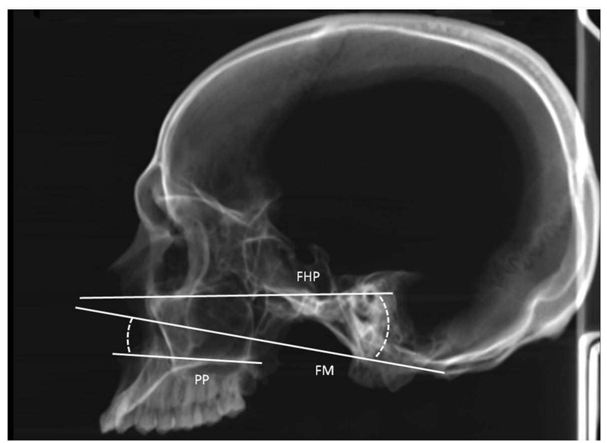 Lateral radiograph of a modem human skull from the