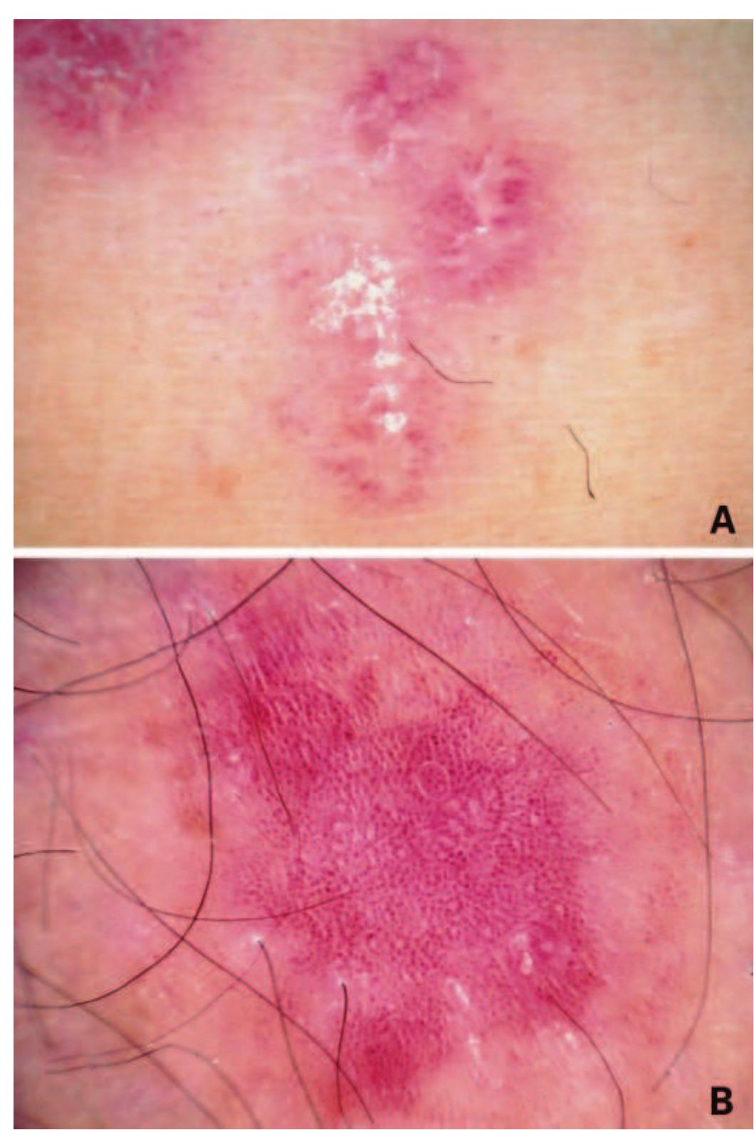 Dermoscopy view of the same lesions as in figure 4. a short,