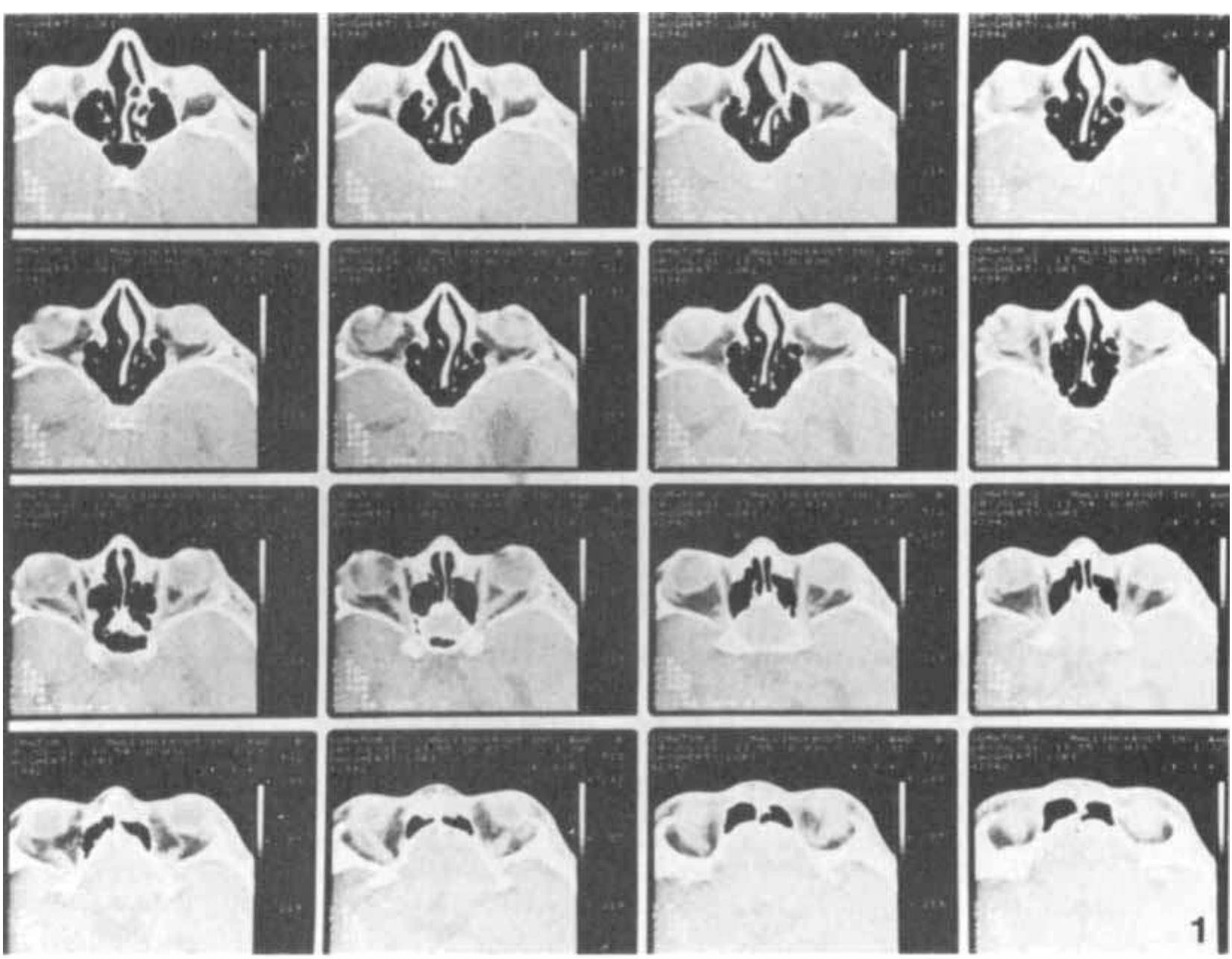 High-resolution ct scan through the facial structures. this