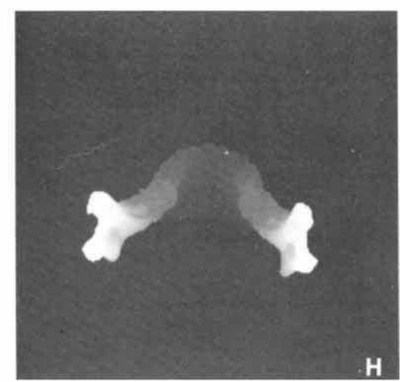 Tal bony surface (note nasal cleft). b. frontal soft tissue