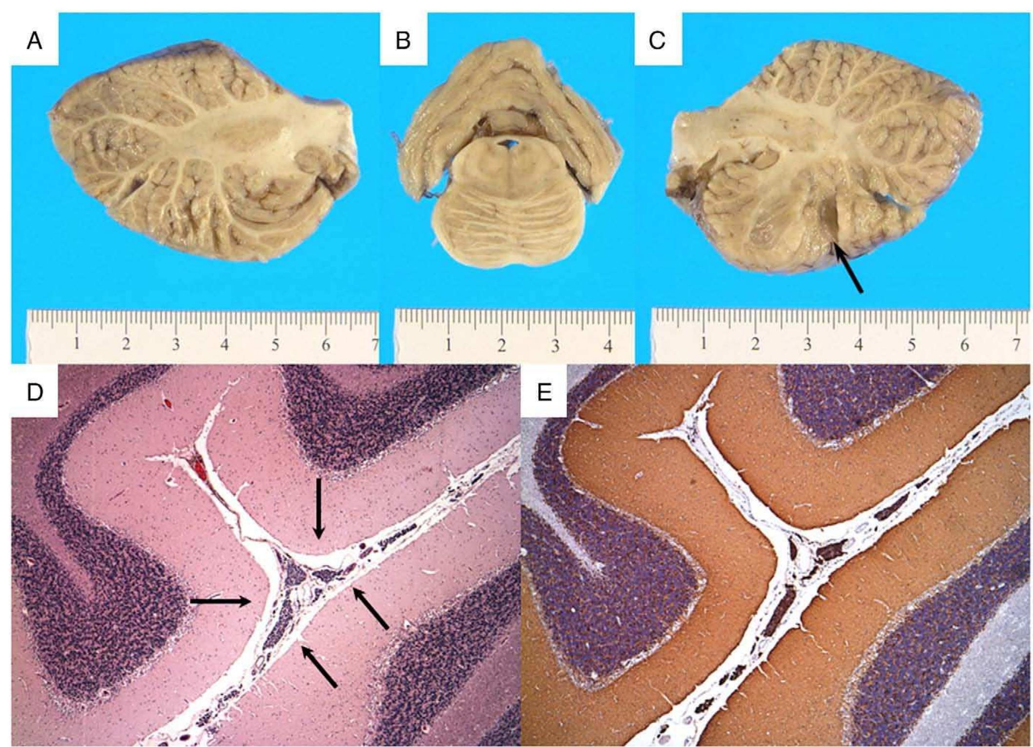 Findings at autopsy. gross examination of the brain (upper